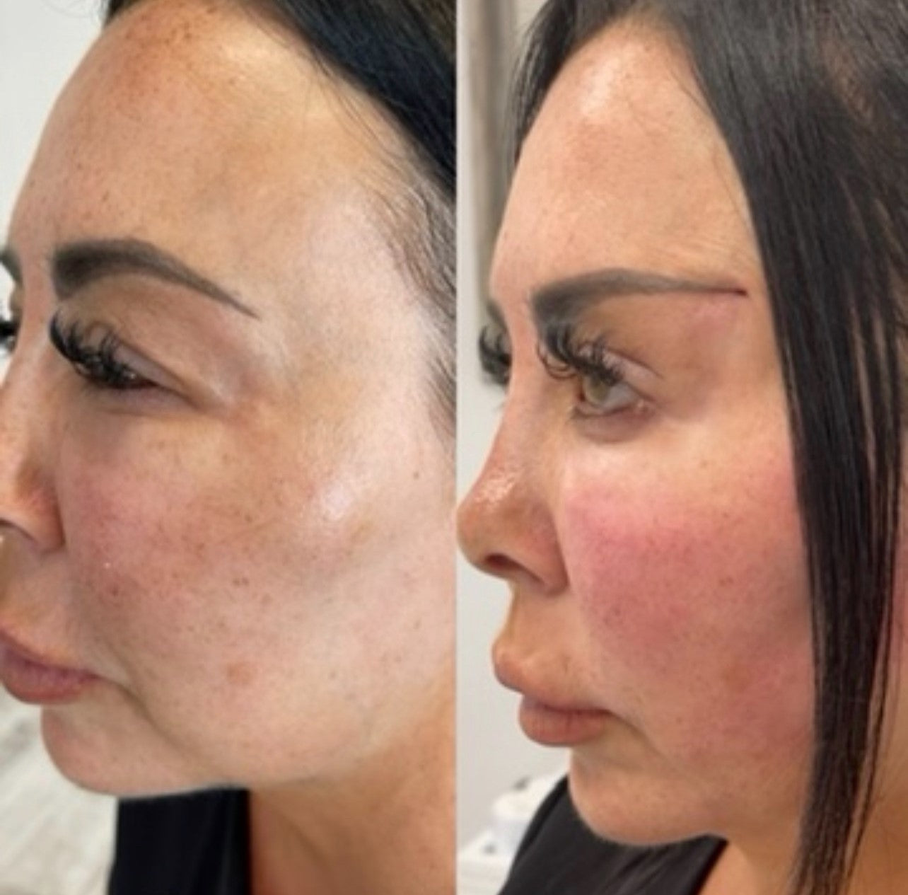 INHOUSE - Cogs, Fox Eye & PDO Thread Course – Cosmetic Aesthetics Ltd